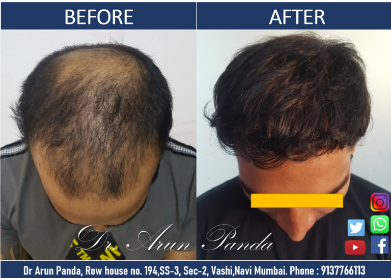 Best Hair Transplant in Navi Mumbai | Dr Arun Panda