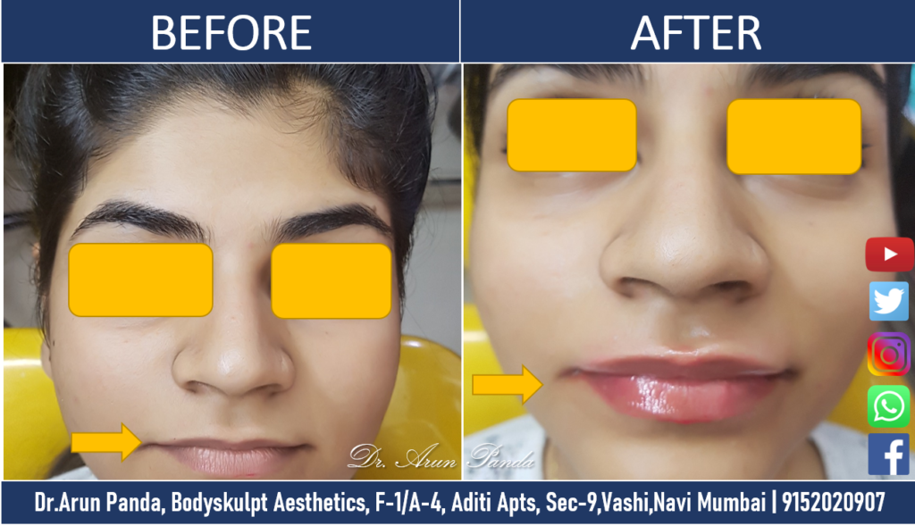 Lip Reshaping Treatment in Navi Mumbai – Cost, Procedure, Side Effects