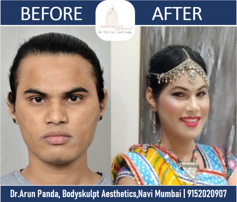 Facial Feminization Surgery in Mumbai, India of a Transgender Patient