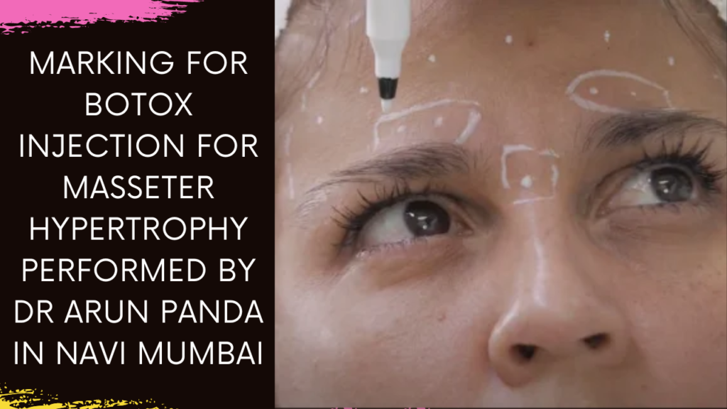 Mastering Masseter Hypertrophy: Botox Injection by Dr. Arun Panda in ...