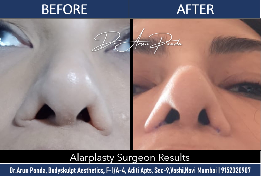 Cost Of Alarplasty in Mumbai - Dr Arun Panda