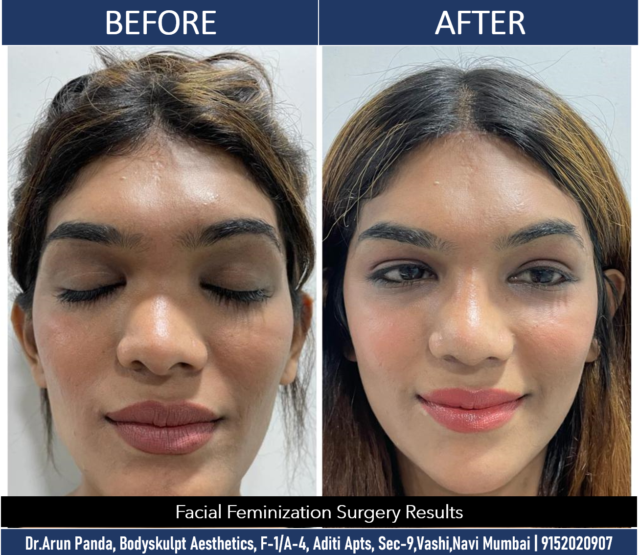 Facial Feminization Surgery in India - Dr Arun Panda