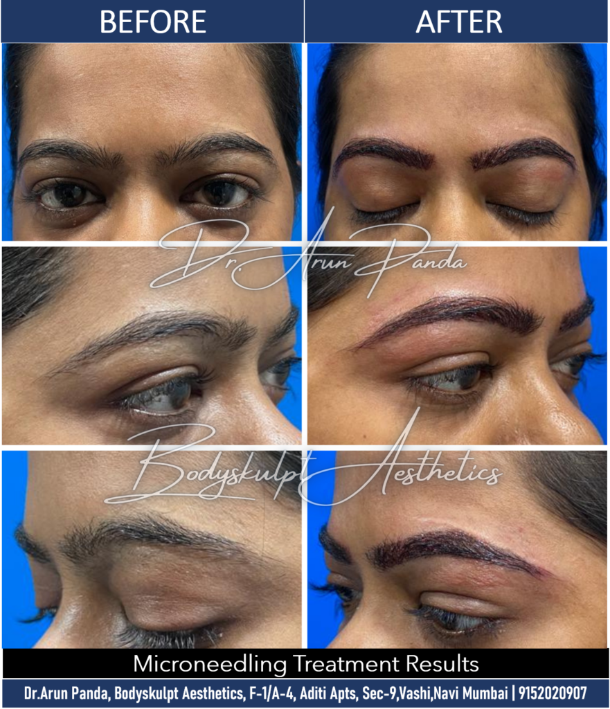 Microneedling for Eyebrow Restoration & Enhancement | Dr Arun Panda