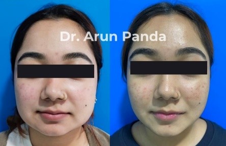 Cost of Buccal Fat Removal: Transform Your Face – Dr Arun Panda