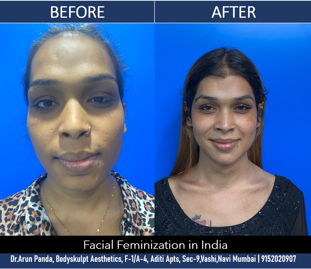 Facial Feminization Surgery In Mumbai India Of A Transgender Patient